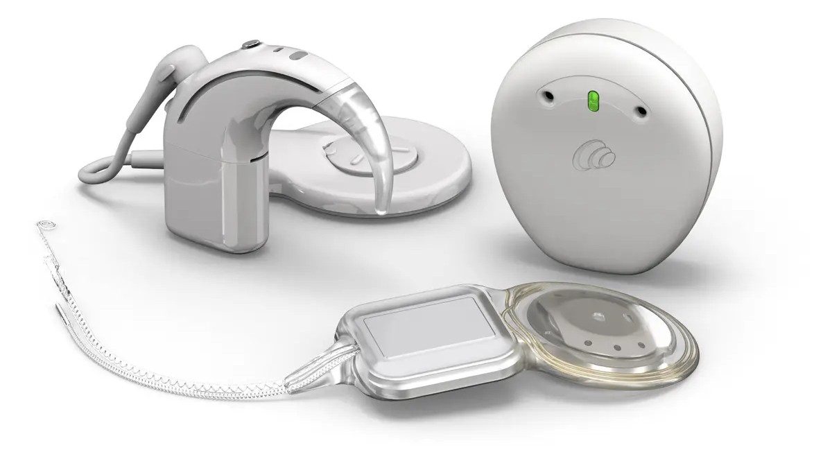 Cochlear lance Nucleus Nexa, un système d’implant cochléaire ...